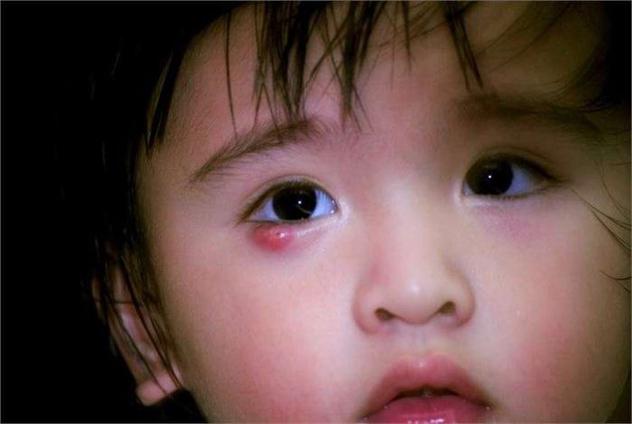Most Effective Tips To Deal With 5 Most Common Eye Diseases In Kids